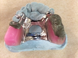 Partial Denture 만드는 과정 - Record base (Wax Rim) : 네이버 블로그