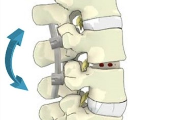 PLIF vs PLF : 네이버 블로그