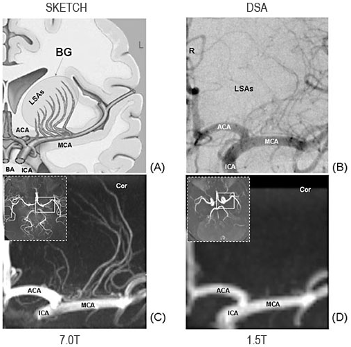 Neuroimaging - CTA, MRA를 이용한 3D imaging : 네이버 블로그