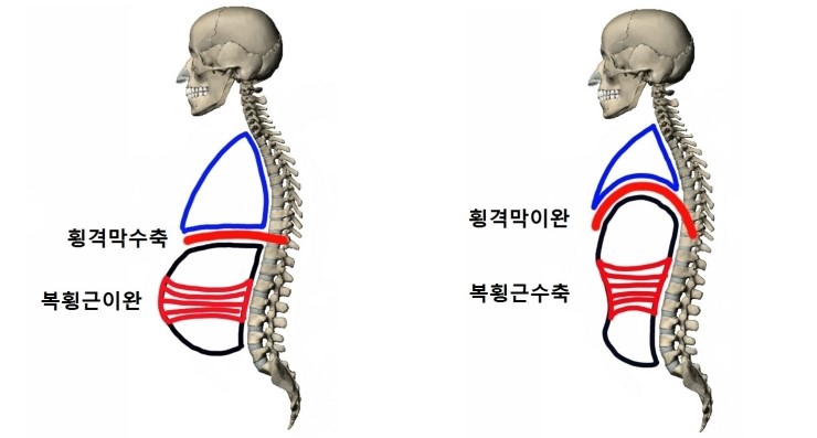 허리디스크 재활운동 허리부상 추간판탈출증 재활운동 4 횡격막 강화 복식호흡 발살바 네이버 블로그