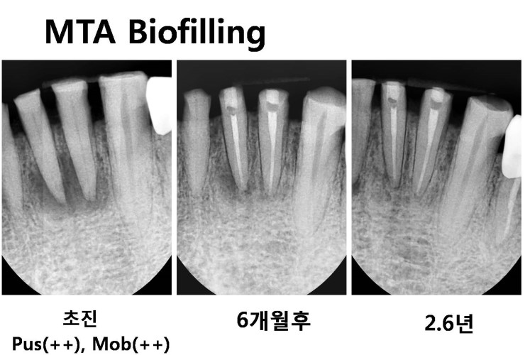 근단농양뿌리염증 통증없는 Mta신경치료 유플러스치과 네이버 블로그