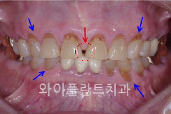 와이플란트치과 치아파임치료 치아파임원인치아파임이유 치아시린이유 치아가 시린이유치아마모치경부마모증 치아시림레진치료