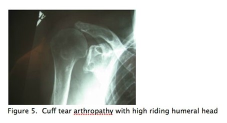 [영상의학] 어깨 MRI (Shoulder MRI) 영상 진단 : 네이버 블로그