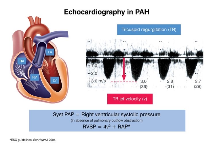 폐동맥 수축기압(PASP; pulmonary artery systolic pressure)과 폐동맥 고혈압(pulmonary ...
