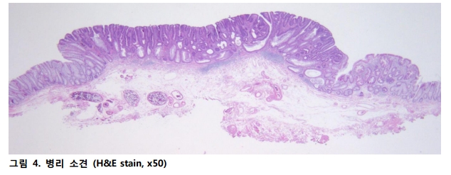 대장의 측방발육형 종양, Colonic laterally spreading tumor(LST) - 대한소화기내시경학회 교육자료 ...