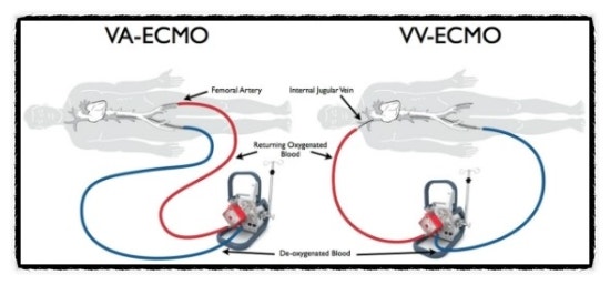 에크모(ECMO)란? ECMO (Extra Corporeal Membrane Oxygenation) : 네이버 블로그