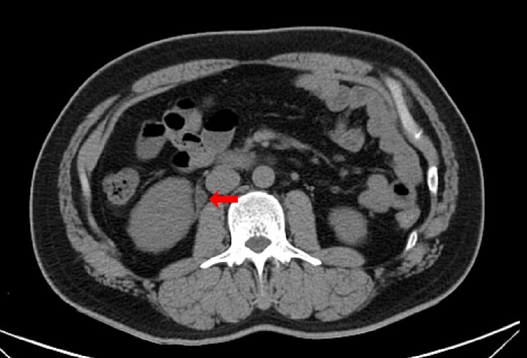 요로결석과 수신증, Ureter stone with hydroureteronephrosis (2) : 네이버 블로그