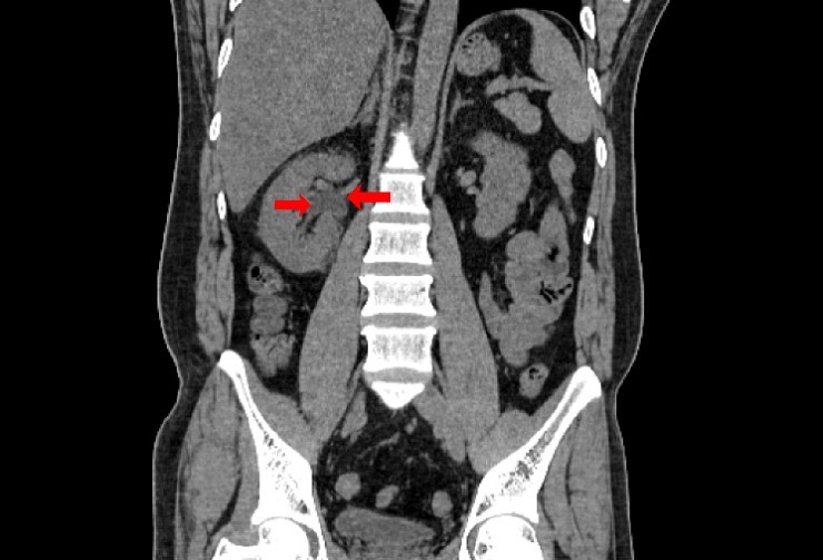 요로결석과 수신증, Ureter stone with hydroureteronephrosis (2) : 네이버 블로그