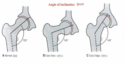 Coxa Vara, Coxa valga : 네이버 블로그