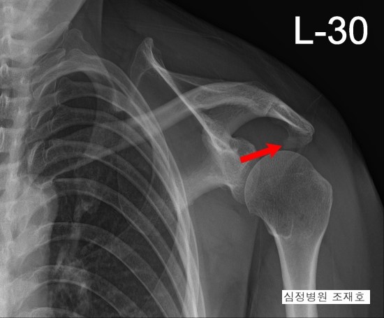 회전근개 파열견갑하근 및 극상근에서의 관절경적 견봉하 감압술 및 회전근개 봉합술arthroscopic Subacromial