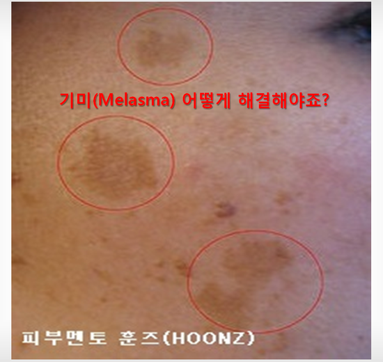 기미melasma 무엇인지 알아보고 해결해요 멜라닌 자외선 색소침착 하이드로퀴논 네이버 블로그