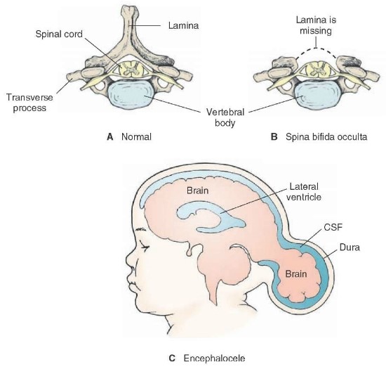 신경계 기형-이분척추(spina bifida: SB) : 네이버 블로그