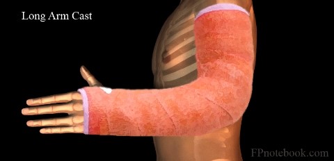 석고붕대(cast)종류와 간호 : 네이버 블로그