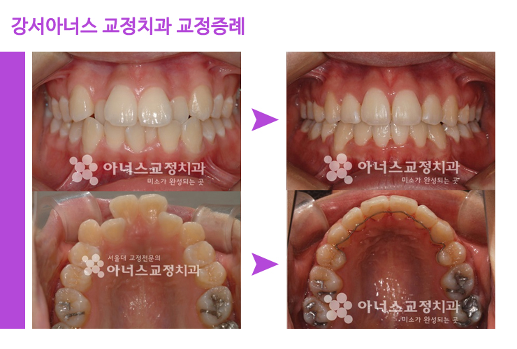 치아교정 부작용 치아표면탈회 잇몸염증 잇몸퇴축 네이버 블로그