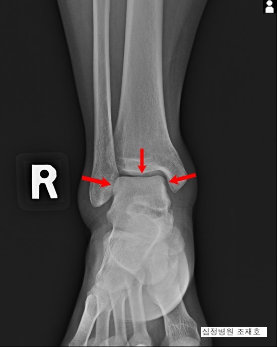 발목의 만성 불안정성에서의 발목 외측 인대 재건술 및 미세천공술 (ankle microfracture, lateral ...