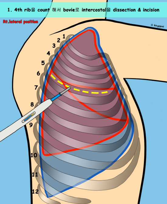 Ivor Lewis OP. 에서 thoracotomy 의 전반부》 : 네이버 블로그