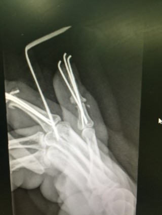 Arthrodesis DIP Joint 3rd finger : 네이버 블로그