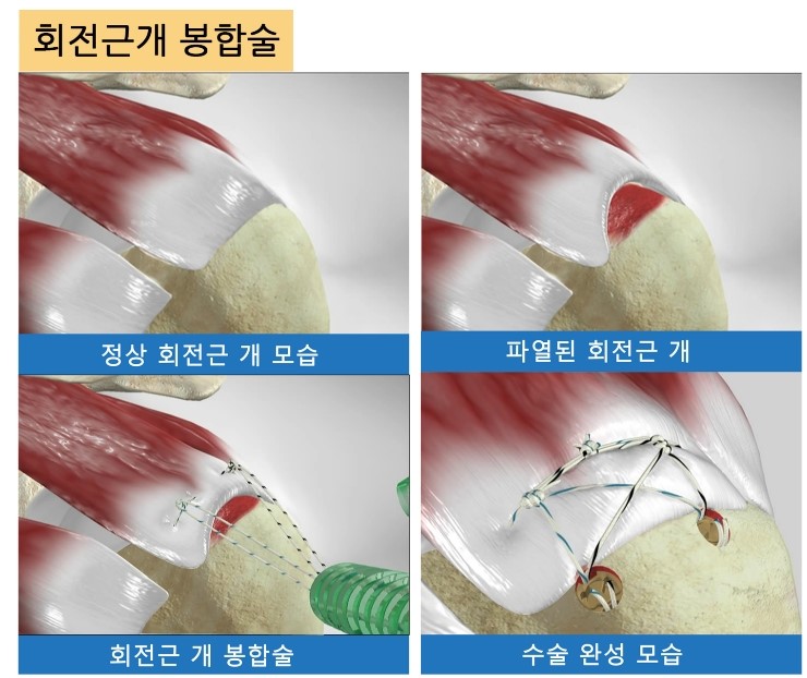 어깨 회전근개 파열 수술 후 관리 네이버 블로그