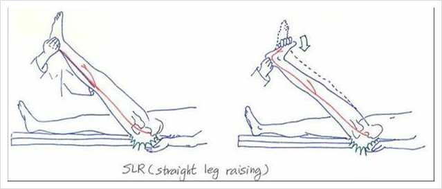 라세그 징후(Lasegue's Sign) 허리통증, 다리저림! 하지직거상 검사(SLR TEST) : 네이버 블로그