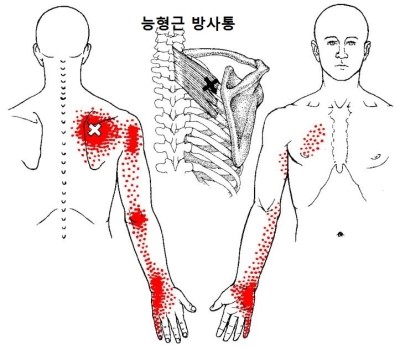 어깻죽지(능형근)통증 - 견갑배신경을 중심으로 : 네이버 블로그