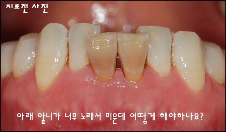 노래진치아변색치아치료치아변색이유 신경치료 후 누렇게 변색된 앞니 부분미백치료로 해결하기실활치미백 네이버 블로그