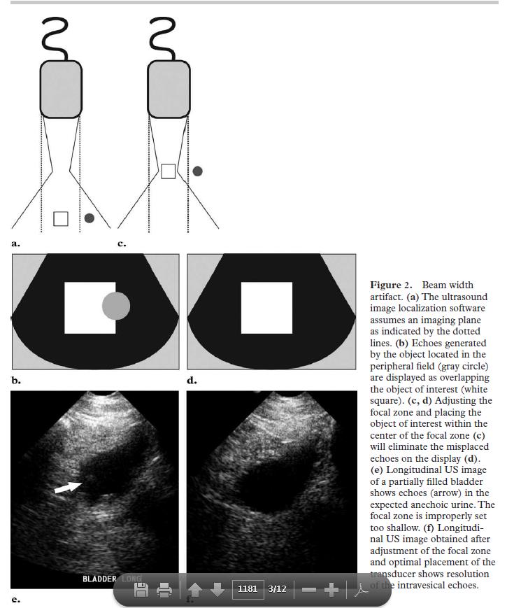 Beam width artifact. : 네이버 블로그