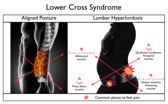 하지 교차 증후군(Lower Crossed Syndrome) - 요추전만과 골반전방경사 문제를 해결해 보도록 하겠습니다 ...