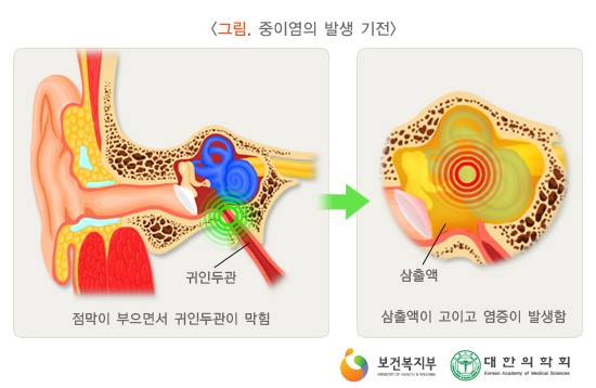 귀 구조 중이가운데 귀4유스타키오관이관귀관귀인두관인두고실관 네이버 블로그