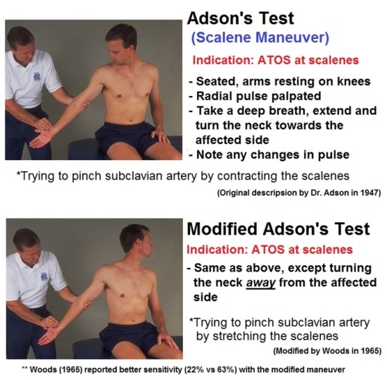 흉곽출구증후군(Thoracic outlet syndrome)의 이학적 검사 : 네이버 블로그