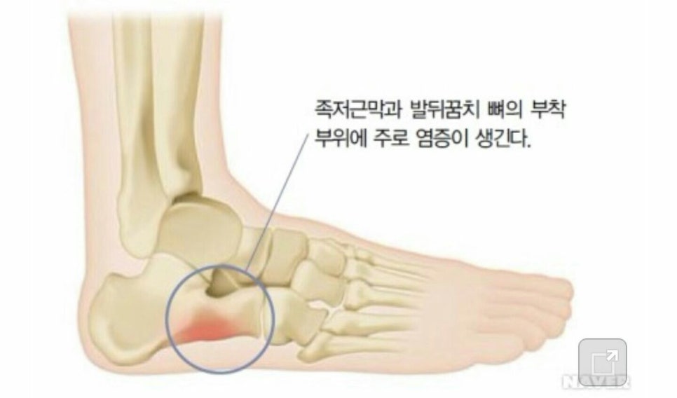 족저근막염 자가치료방법 골프공 스트레칭마사지가 좋아요 네이버 블로그