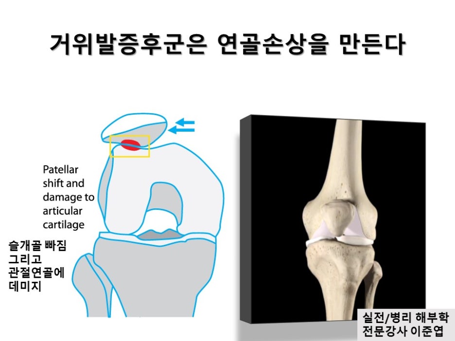 깅의제목 무릎내측통증의 시작인 거위발 근육에 대하여 알아보자 강사 이준엽pt 네이버 블로그