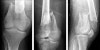 대퇴골 원위부 골절distal Femoral Fracture 교통사고 후 대퇴골 원위부가 부러졌어요 네이버 블로그