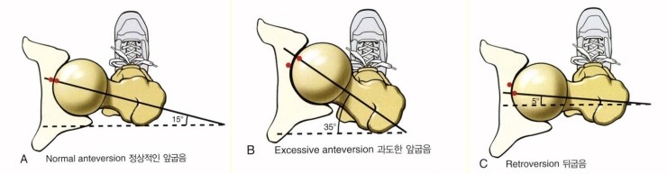 대퇴전방활주 증후군(femoral anterior glide syndrome) : 네이버 블로그