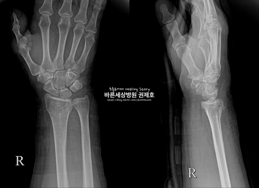 손목골절 정복술 및 내고정술 어느 요리사의 소중한 손목 네이버 블로그