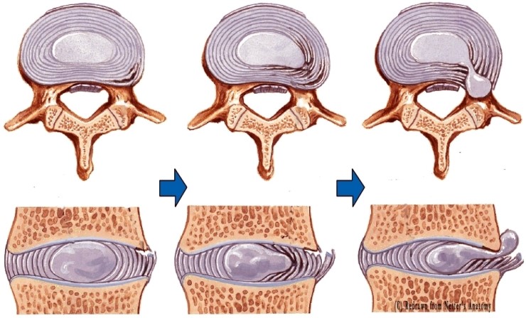 척주, vertebral column, 고리뿌리(pedicle), 고리판 (lamina) 척수의 겉모습, 척추사이원반 ...