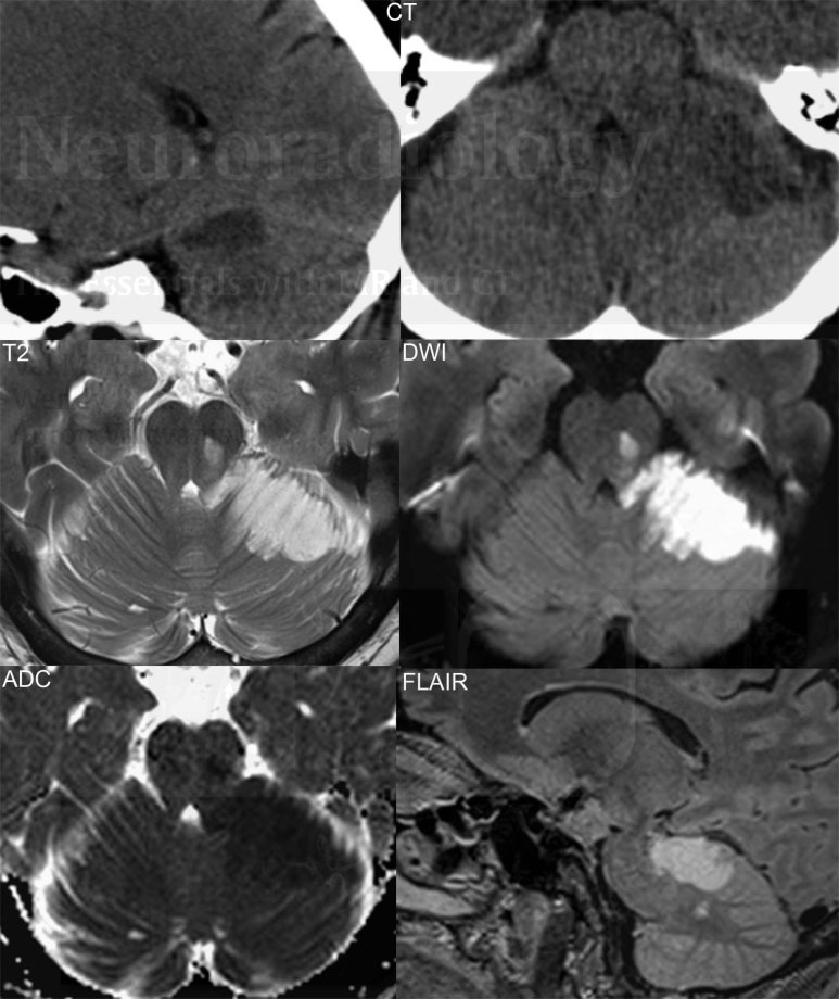 소뇌 경색cerebellum Infarction 정상 기능 증상 예후 네이버 블로그