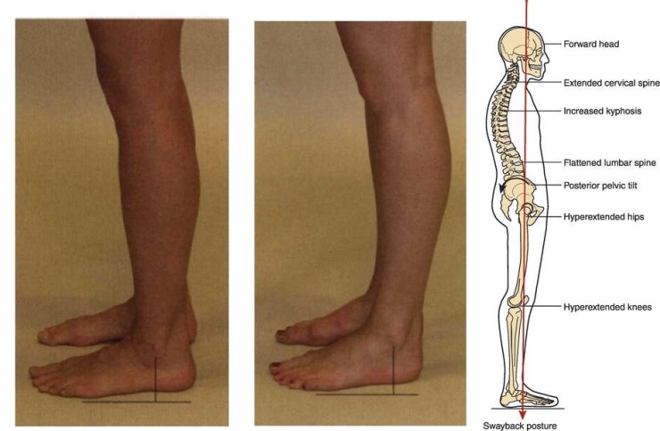 [근막경선해부학] 표면후방선(the superficial back line) 2 - 발뒤꿈치에서 좌골결절까지 : 네이버 블로그
