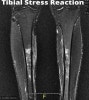 정강이 통증shin Splints 무리하게 달리기를 한 뒤 종아리 앞쪽에 통증이 있어요 네이버 블로그