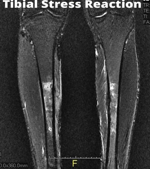 정강이 통증shin Splints 무리하게 달리기를 한 뒤 종아리 앞쪽에 통증이 있어요 네이버 블로그