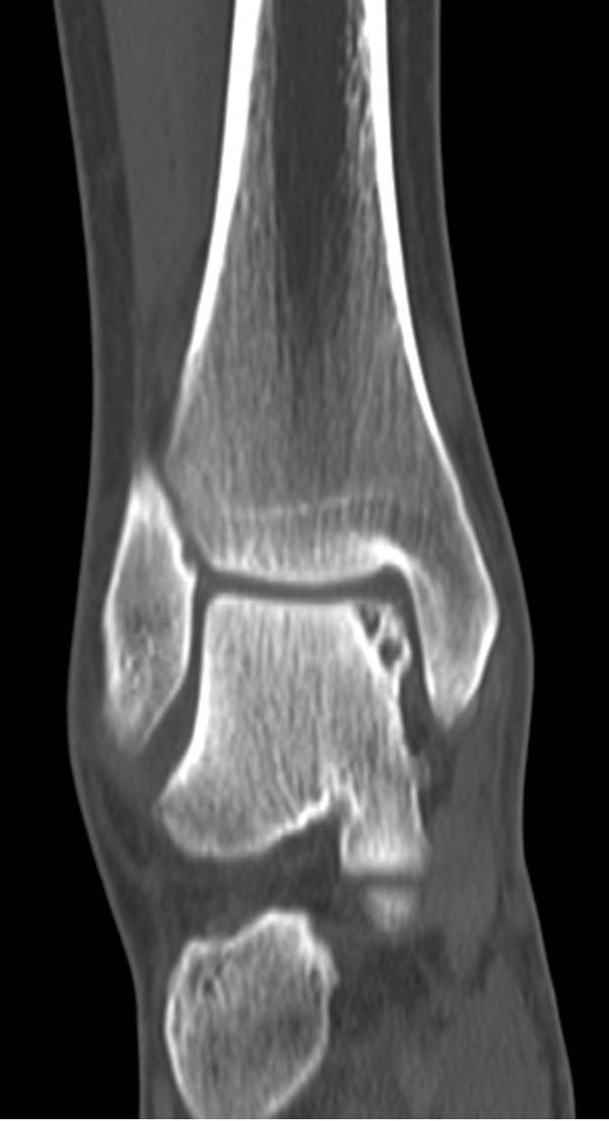 거골의 박리성 골연골염osteochondral Lesion Of Talus 아무것도 하지 않는데 발목의 안쪽이 갑자기