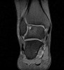 거골의 박리성 골연골염osteochondral Lesion Of Talus 아무것도 하지 않는데 발목의 안쪽이 갑자기
