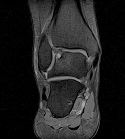 거골의 박리성 골연골염osteochondral Lesion Of Talus 아무것도 하지 않는데 발목의 안쪽이 갑자기