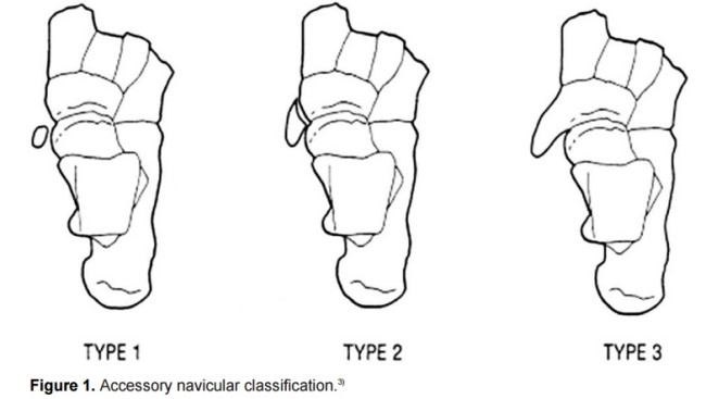 부주상골 증후군(Accessory navicular) : 내측 복사뼈 아래쪽에 통증이 있어요 : 네이버 블로그