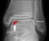 거골의 박리성 골연골염osteochondral Lesion Of Talus 아무것도 하지 않는데 발목의 안쪽이 갑자기