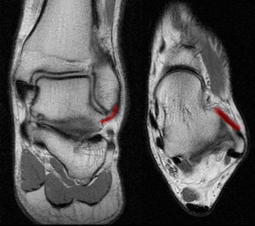 발목 관절의 MRI anatomy : 네이버 블로그