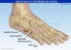 제5중족골 골절5th Metatarsal Fracture 계단에서 발을 삐끗한 뒤 발의 외측이 아파요 네이버 블로그