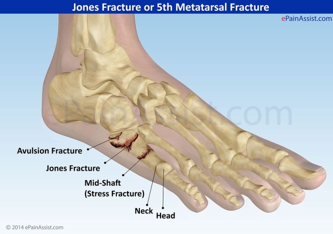 제5중족골 골절(5th metatarsal fracture) : 계단에서 발을 삐끗한 뒤 발의 외측이 아파요 : 네이버 블로그