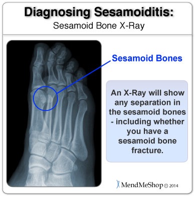 종자골 골절(Sesamoid fracture, Sesamoiditis) : 지속적으로 조깅을 하고 나서 엄지발가락 아래가 아파요 ...