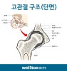 고관절인공관절 수술 기구 § 인공관절수술잘하는곳 웰튼병원 고관절통증 대표질환별 수술사례 대퇴골두무혈성괴사퇴행성관절염