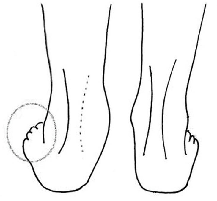 Posterior Tibialis Tendon Dysfunction(PTTD) Rehabilitation - 후경골근 기능부전 ...
